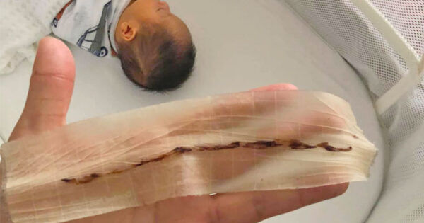 Birth Story: 'My c-section scar reminds me of my strength' | Mum's ...